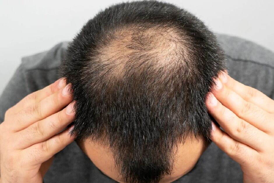 Remédio contra calvície é ligado a maior risco de depressão e suicídio ...